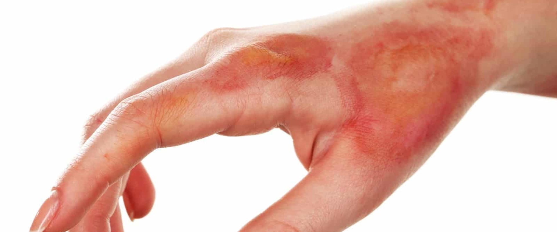 The Dangers of Leaving a Second-Degree Burn Untreated