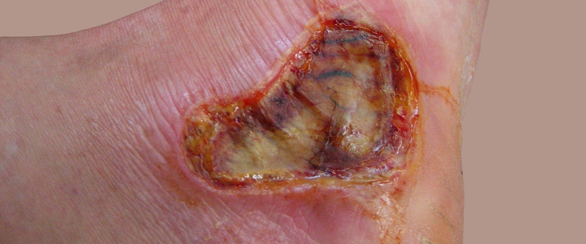 The Healing Process of Burns: What You Need to Know