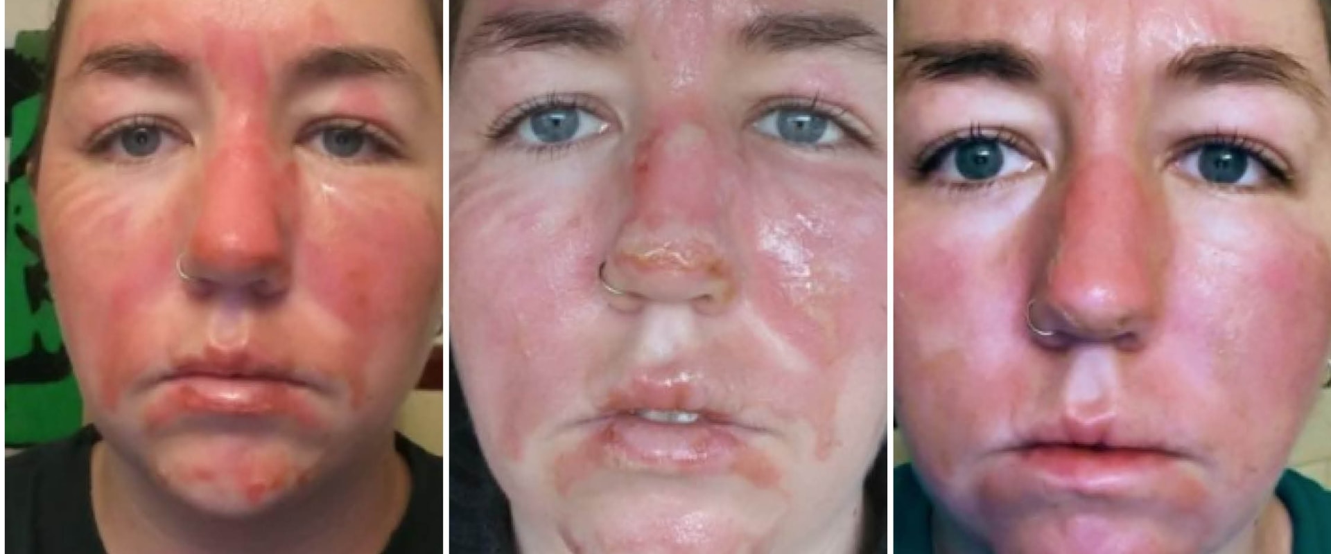 The Healing Process of Second-Degree Burns: What to Expect and How to ...