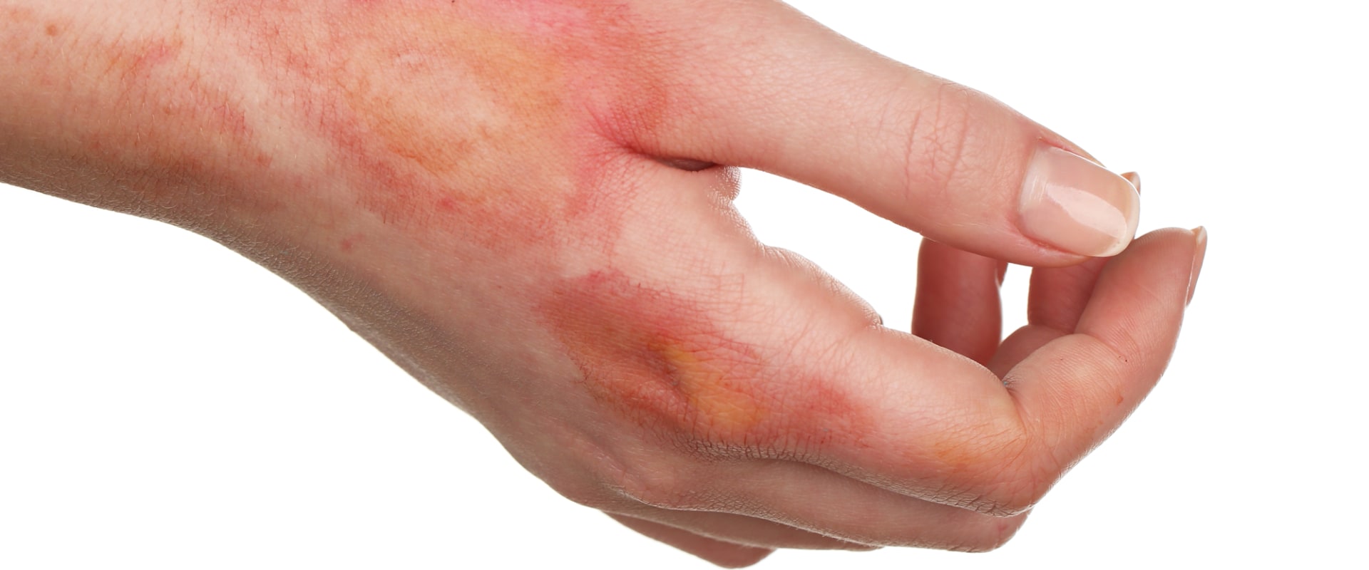 The Importance of Identifying and Treating Burn Infections